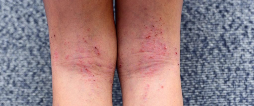 Atopik Dermatit (Egzema) - Doç. Dr. Esra Toprak Kanık